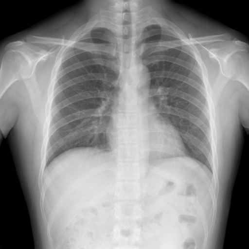 chest x ray images Object Detection Model by Willy