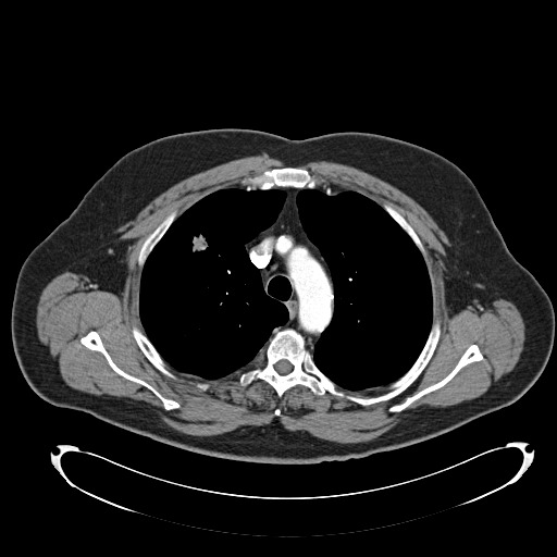cancer Object Detection Model by data