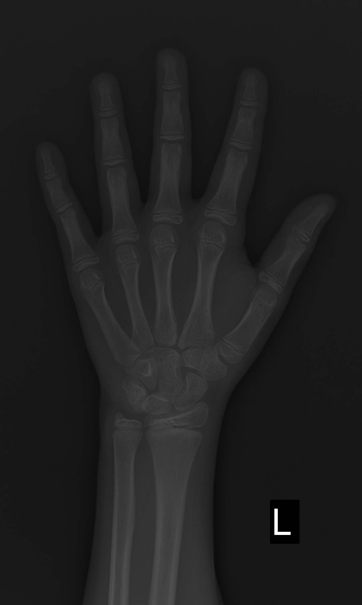 Bone Age (Cropping YOLO) Object Detection Dataset by Object Detection for Cropping Bone Age