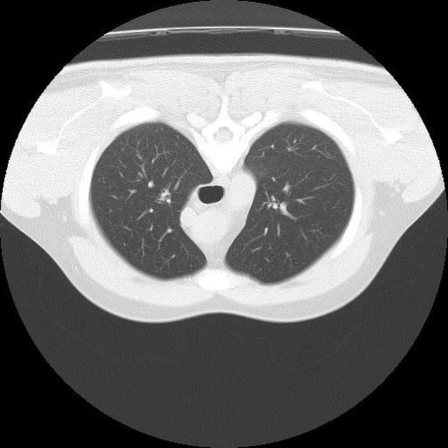 lung Object Detection Dataset by Iza