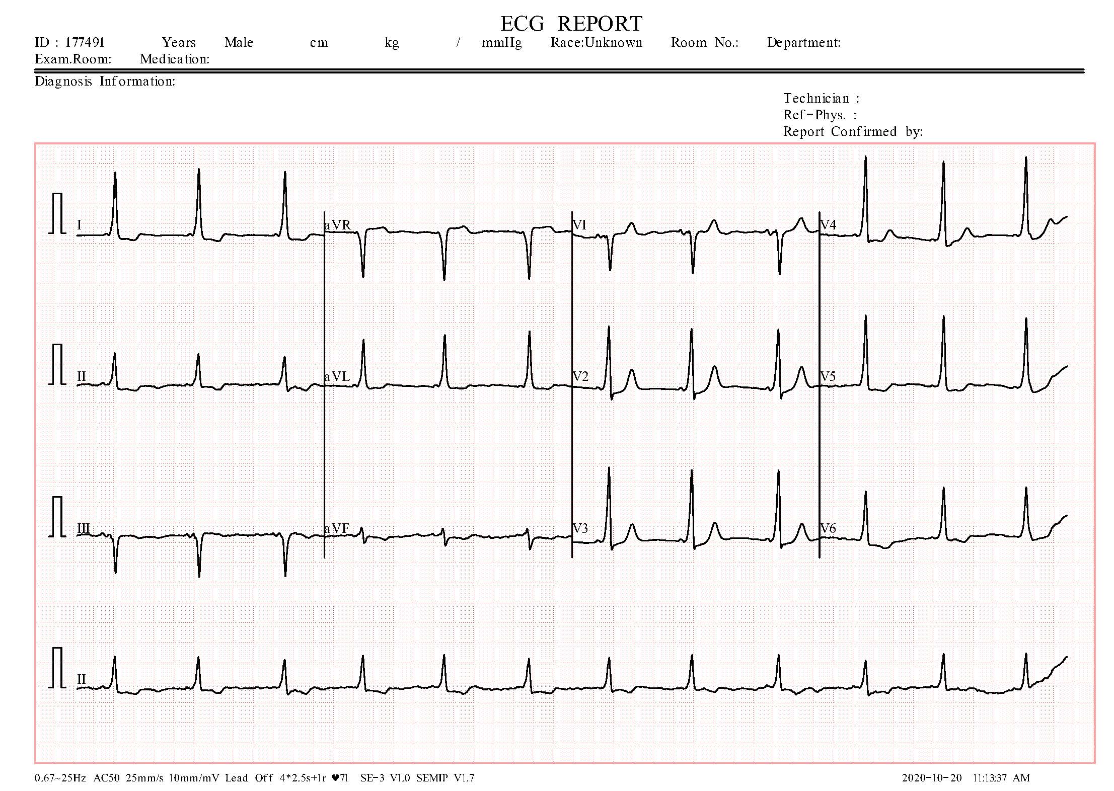 ecg Classification Dataset by deep learning