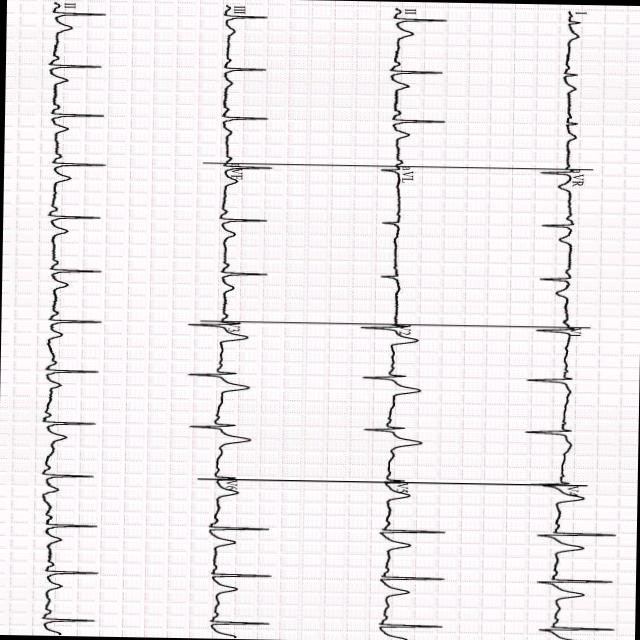 Ecg Classification Model By Deep Learning