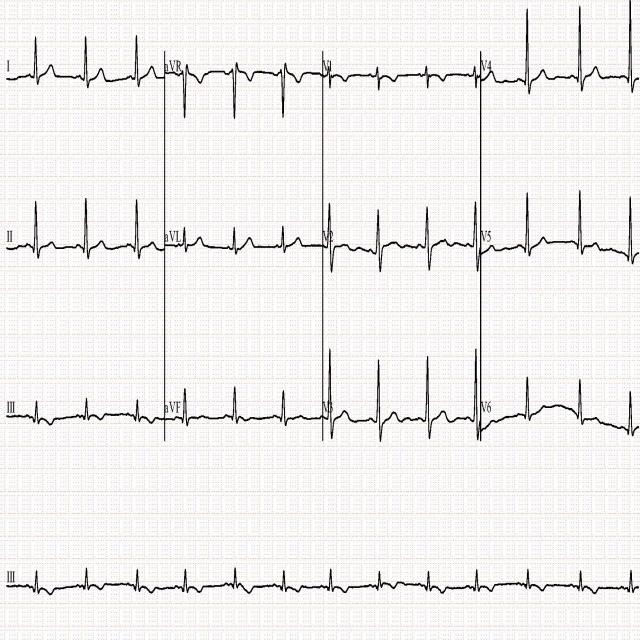 five class ECG image Classification Dataset by deep learning