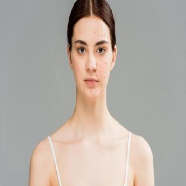 Acne_Detection_Sai Object Detection Dataset by AcneDetection Acne_Detection_Sai Object Detection Dataset by AcneDetection