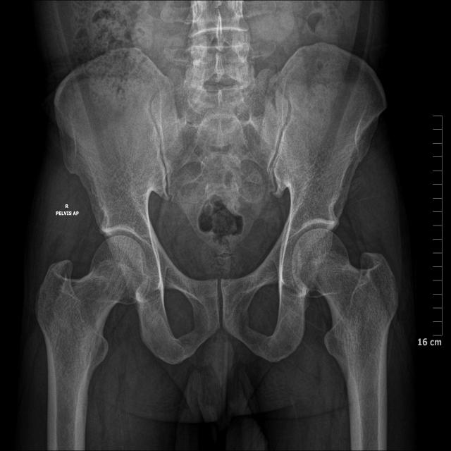 PoC_Femur_Segmentation Instance Segmentation Dataset by HipXrays