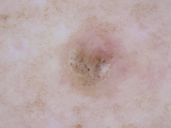 skin cancer Object Detection Dataset by wipro