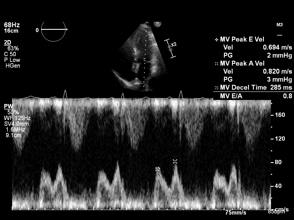 mitral adult echo Instance Segmentation Model by NabFetalUS