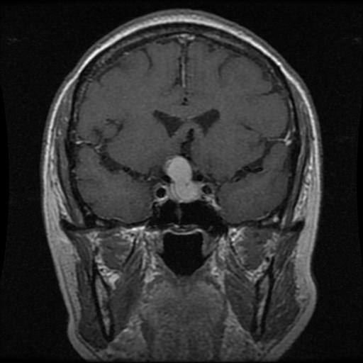 Pituitary Tumor Instance Segmentation Dataset And Pre Trained Model By Free Plan