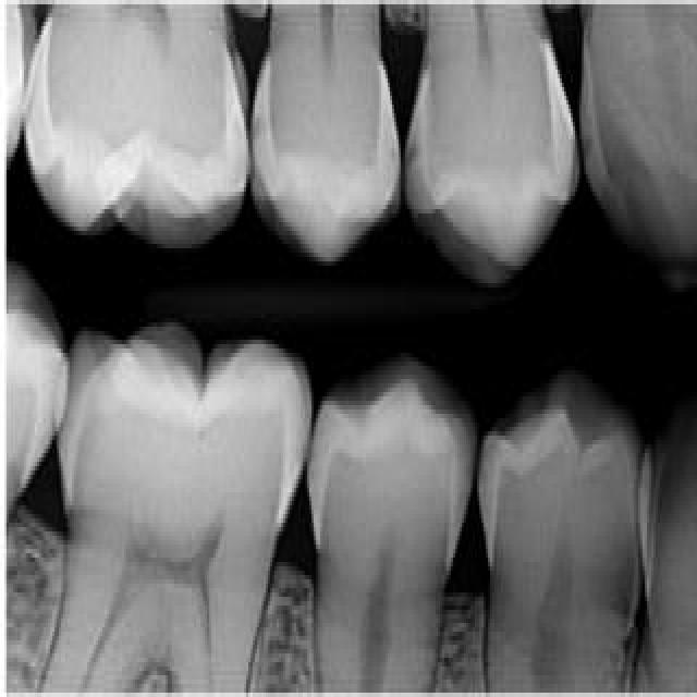 coco_caries Object Detection Dataset by cocoyaml