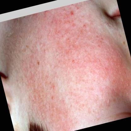 Face Diseases Detection Classification Model by Skin Disease detetcion