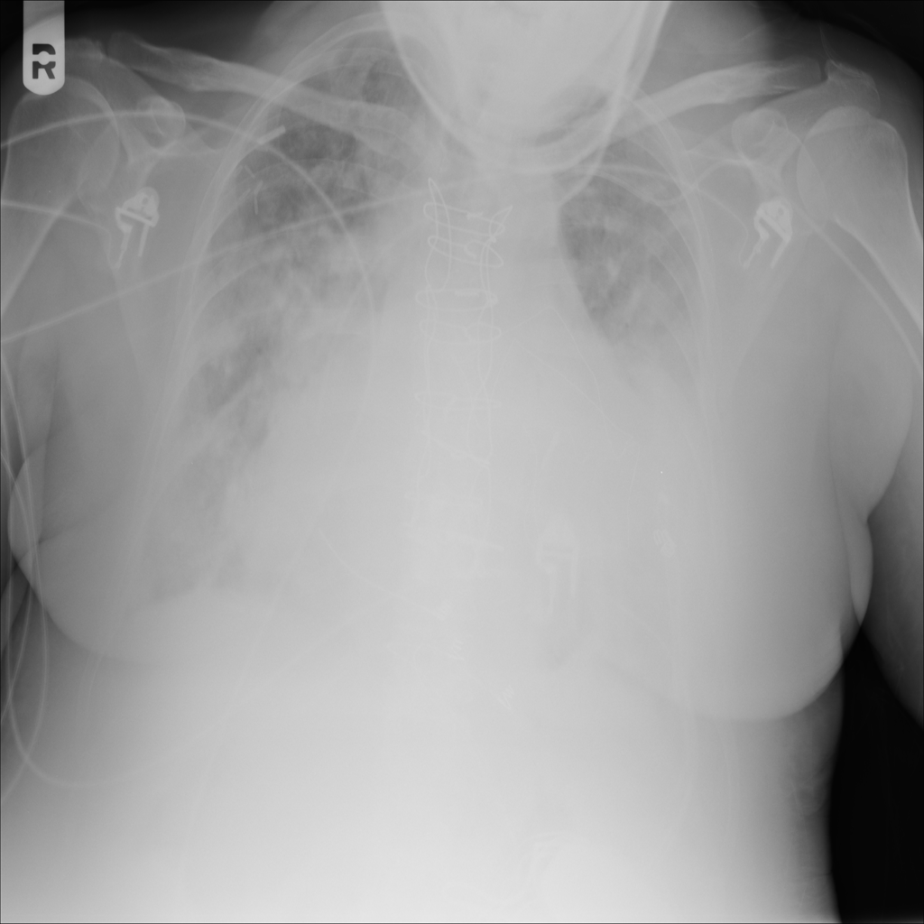 Consolidation Chest X Ray Data Object Detection Dataset By Pneumothorax Chest Xray Data