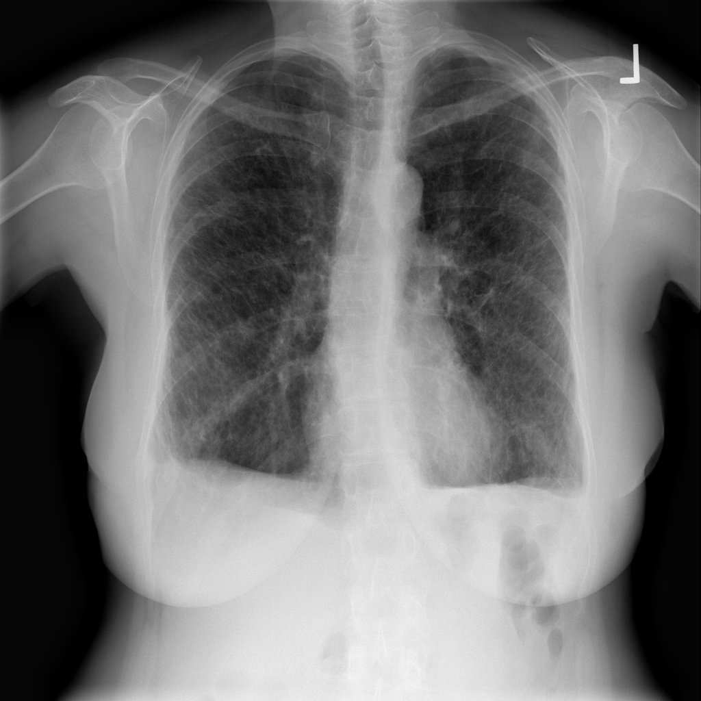 Fibrosis-Pneumothorax Segment Instance Segmentation Dataset (v1, 2024 ...