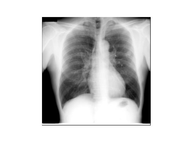 Lungs detection Object Detection Dataset by ADLHW4