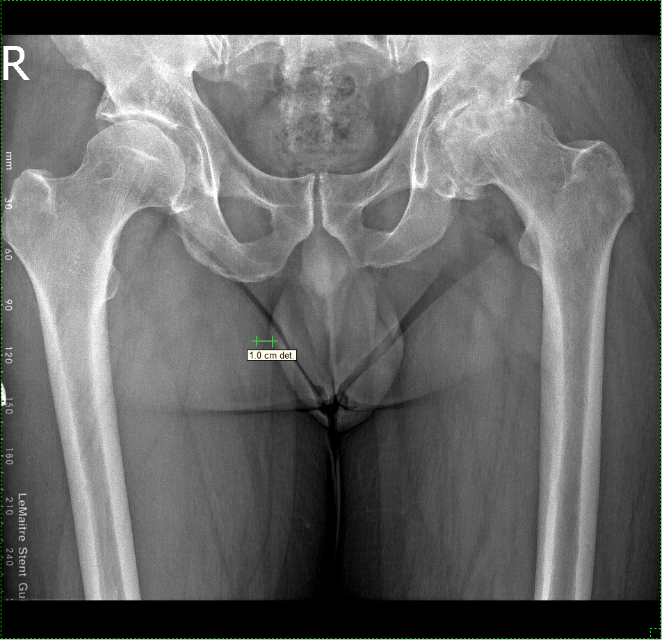 Hip Joint Detection Object Detection Dataset And Pre Trained Model By