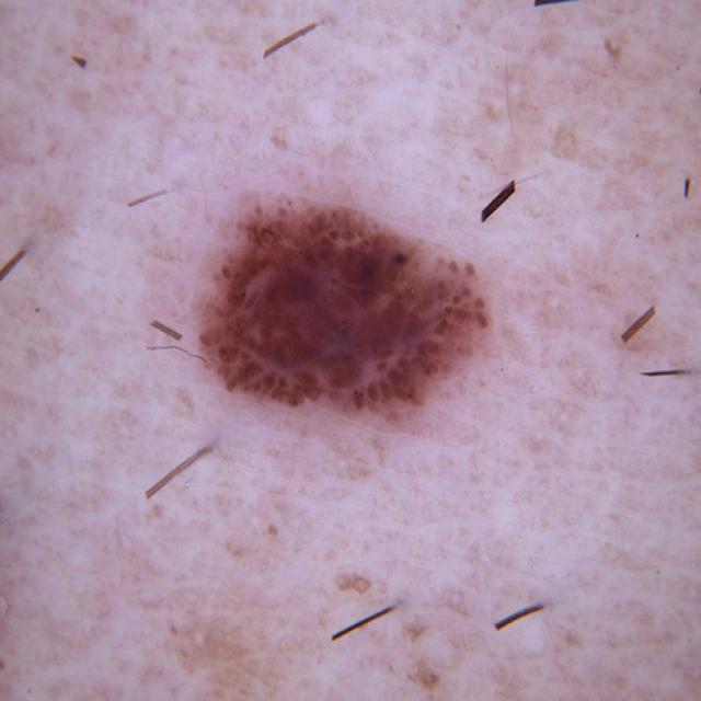 melanoma Classification Dataset by AITU