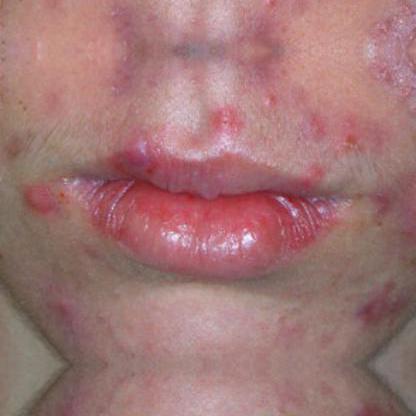 ACNEDet v1 Object Detection Dataset and Pre-Trained Model by Thaiancient