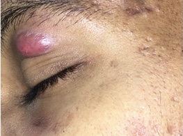 acne classify Classification Dataset by Thaiancient