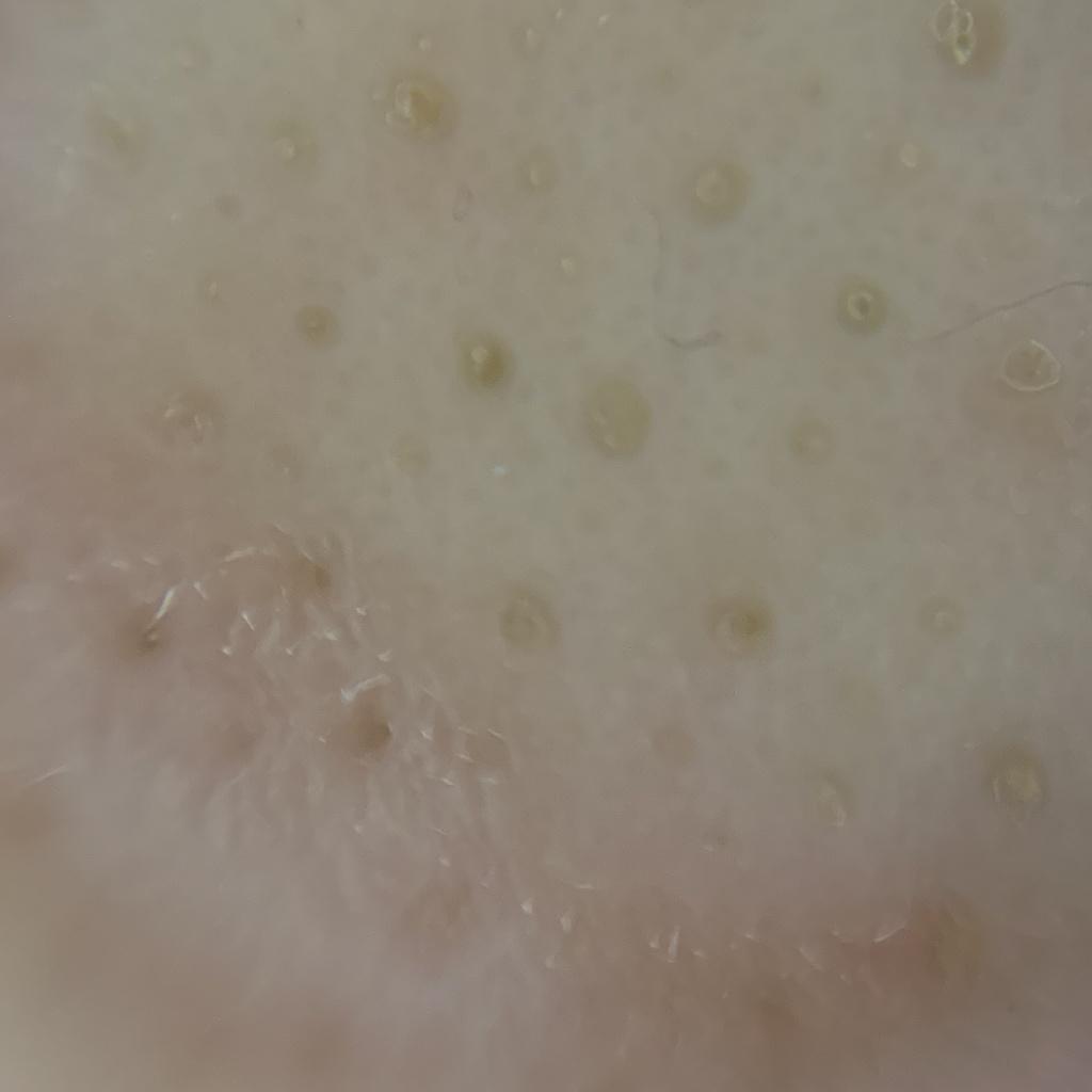 DermaScan AI - Roboflow Universe