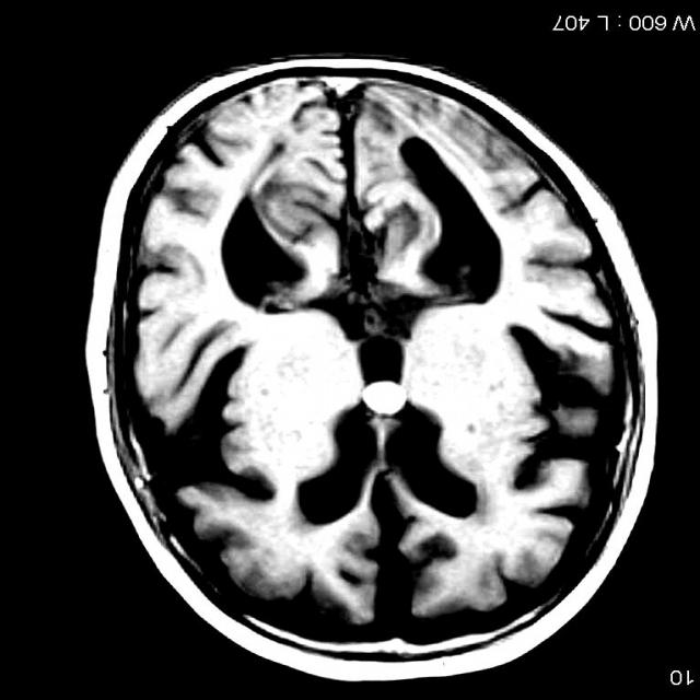 Brain Tumor Detection Object Detection Dataset And Pre Trained Model By Priyadharshini R