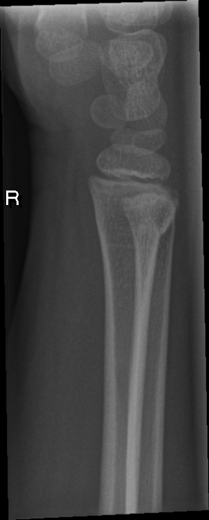 Wrist Fracture Object Detection Dataset By Object Detection