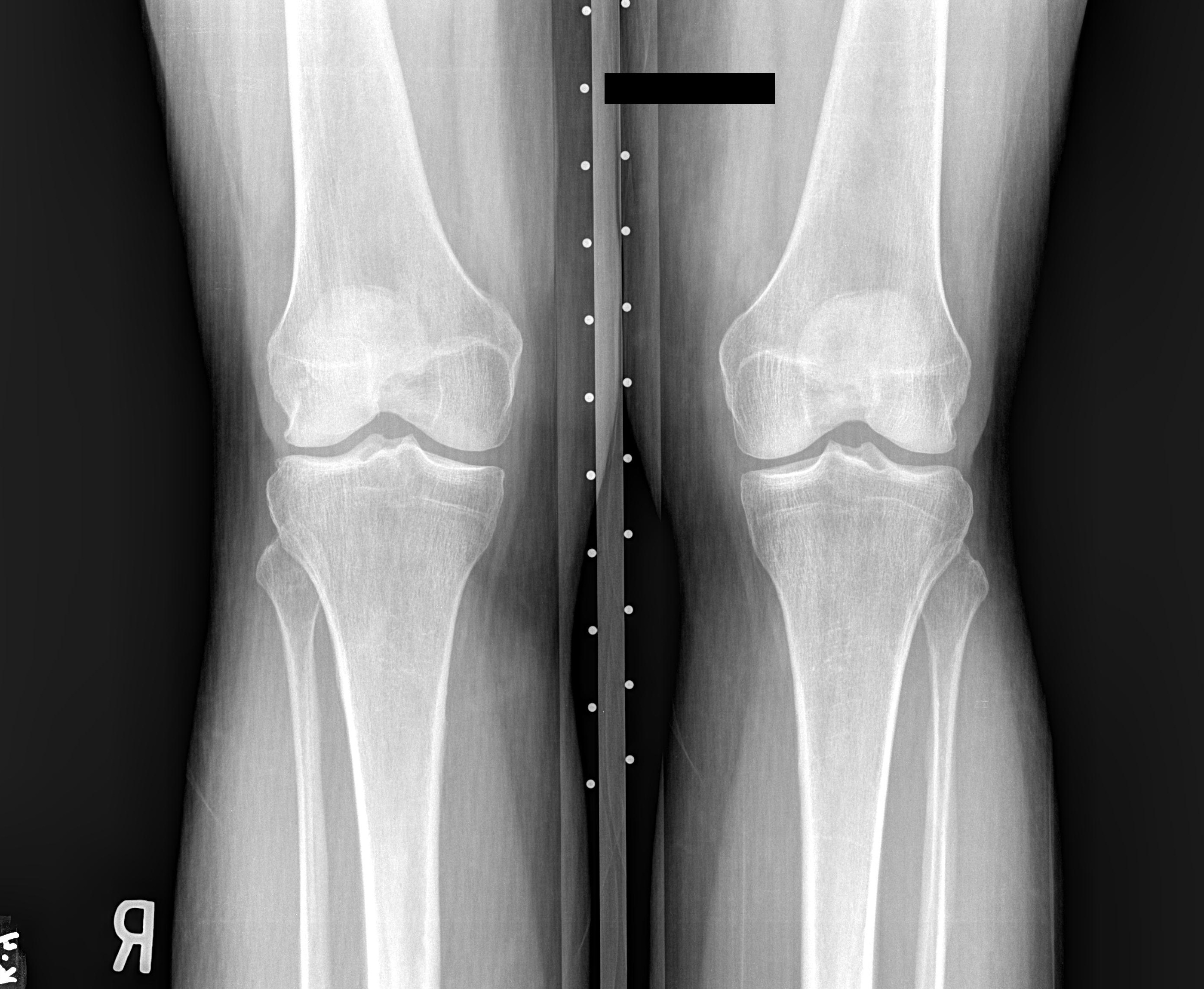 Bilateral PAKnee Xray Object Detection Dataset by ExtractKnee