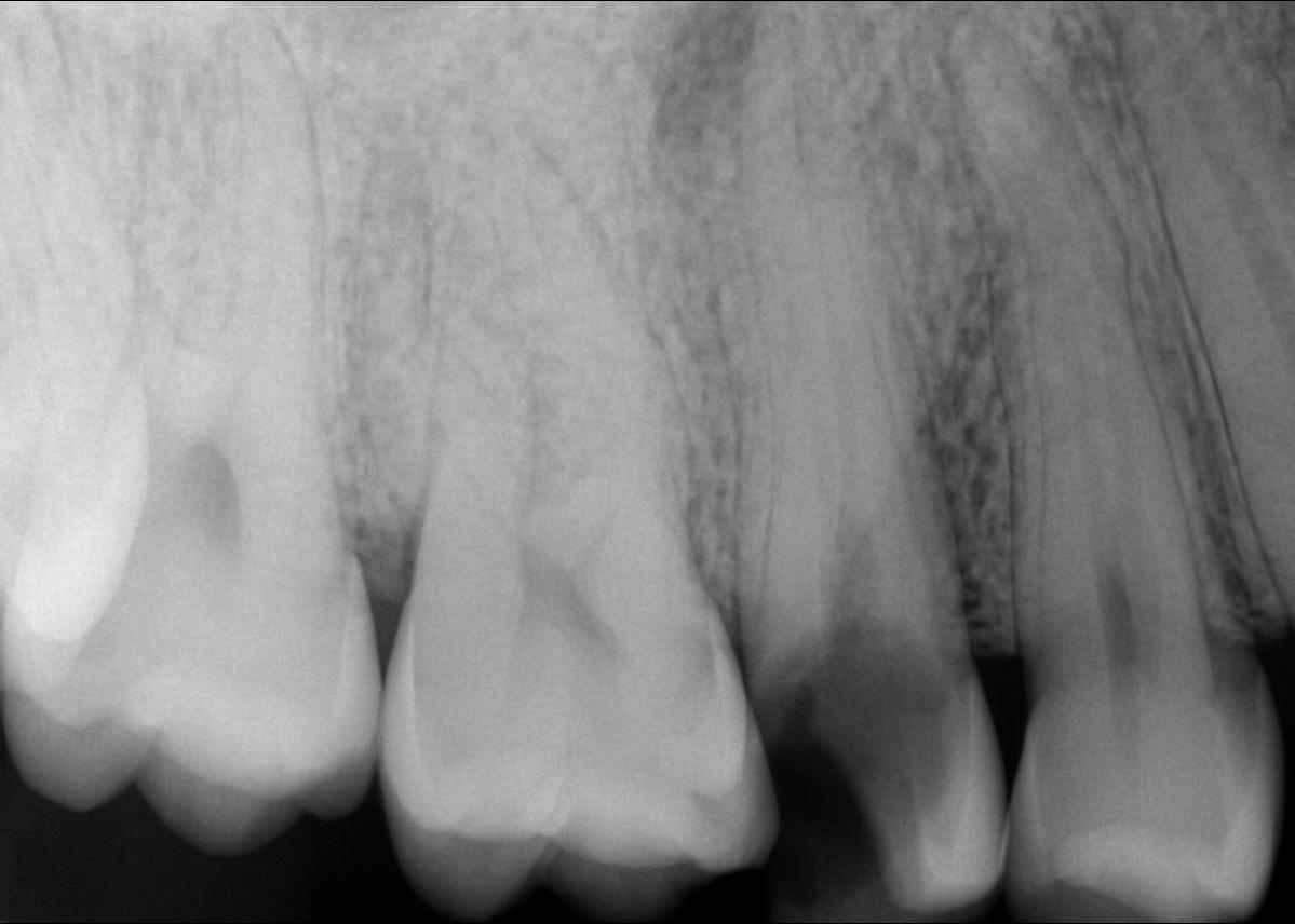 Cavities Instance Segmentation Dataset By Dental Tooth Detection