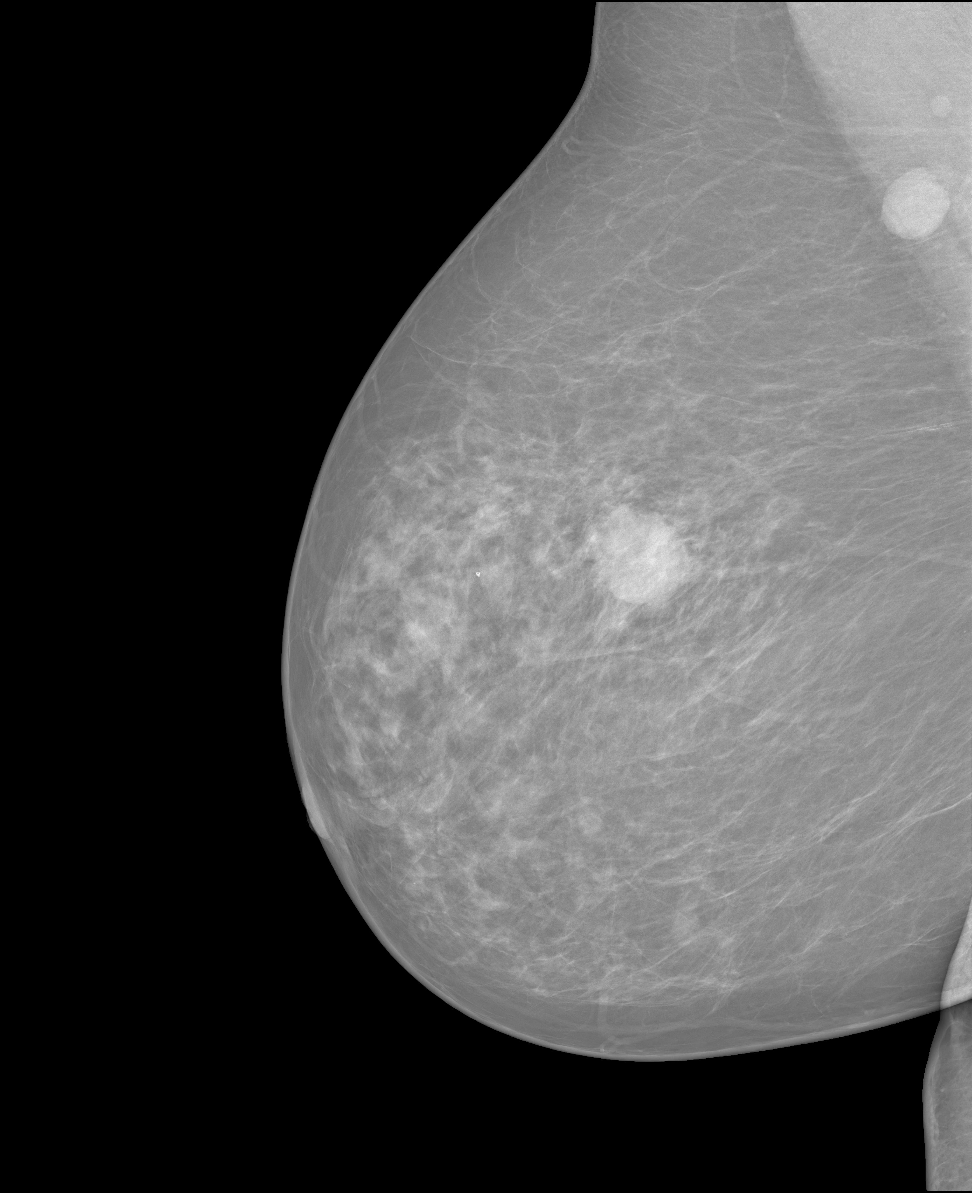 Mammography Mass Detection Object Detection Dataset And Pre Trained