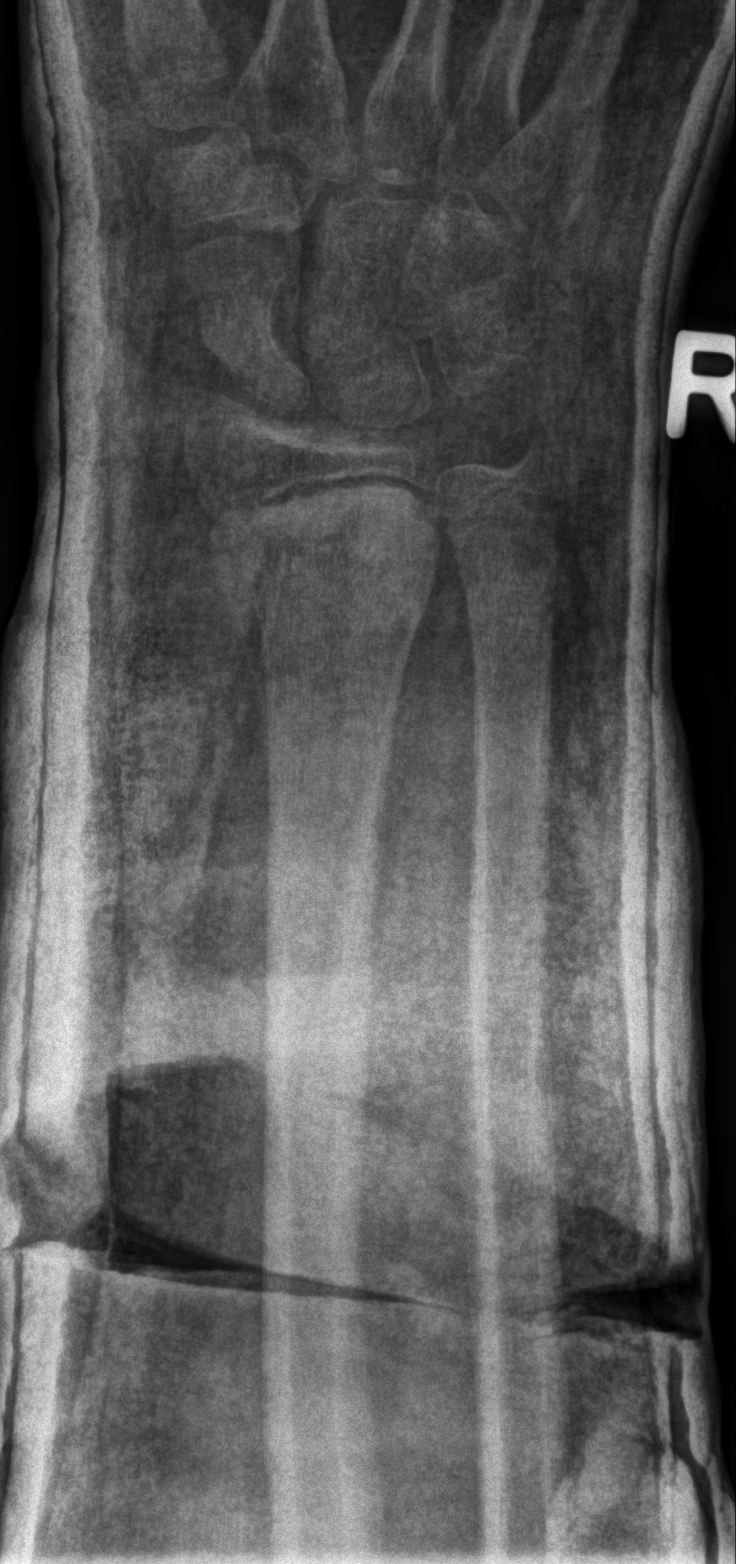 Wrist Fracture 9550 Object Detection Dataset And Pre Trained Model By
