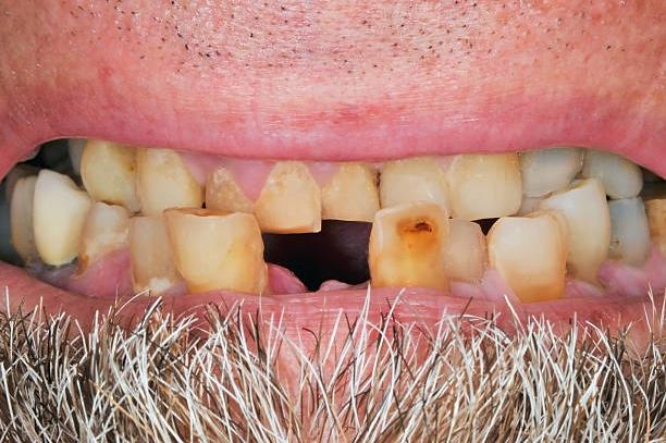 Caries Instance Segmentation Dataset by Dentaldata