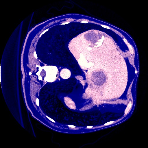 TUMOR_DETECTIO_1 Object Detection Dataset by frank