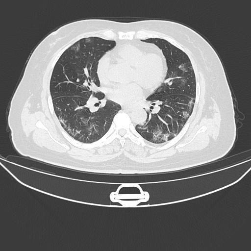 Pneumonia Detection Object Detection Dataset And Pre Trained Model By Wrb