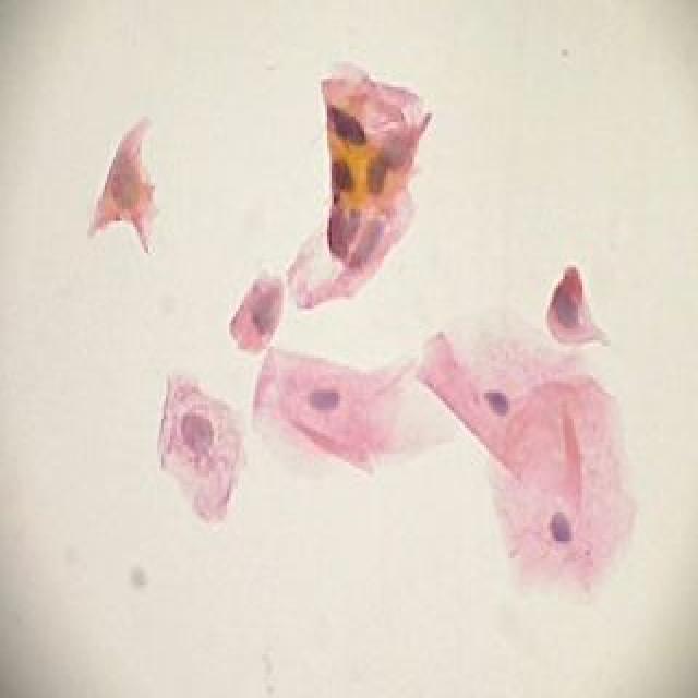 Cervical abnormal cells finder Object Detection Dataset by BhD WorkSpace