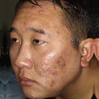 Deteksi acne Object Detection Dataset by acne