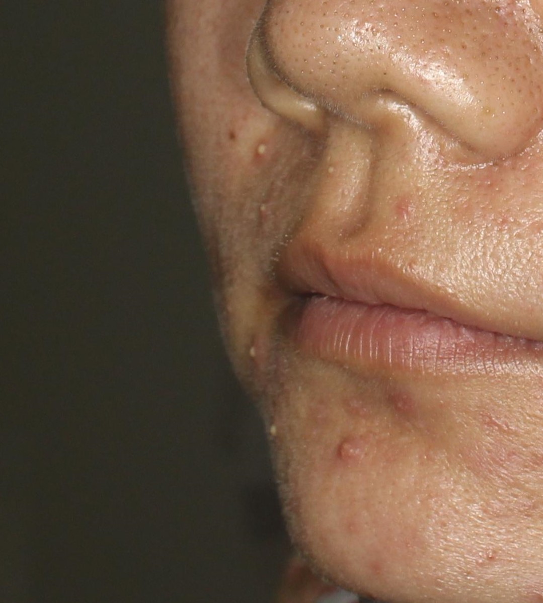 Jerawat Object Detection Model By Acne