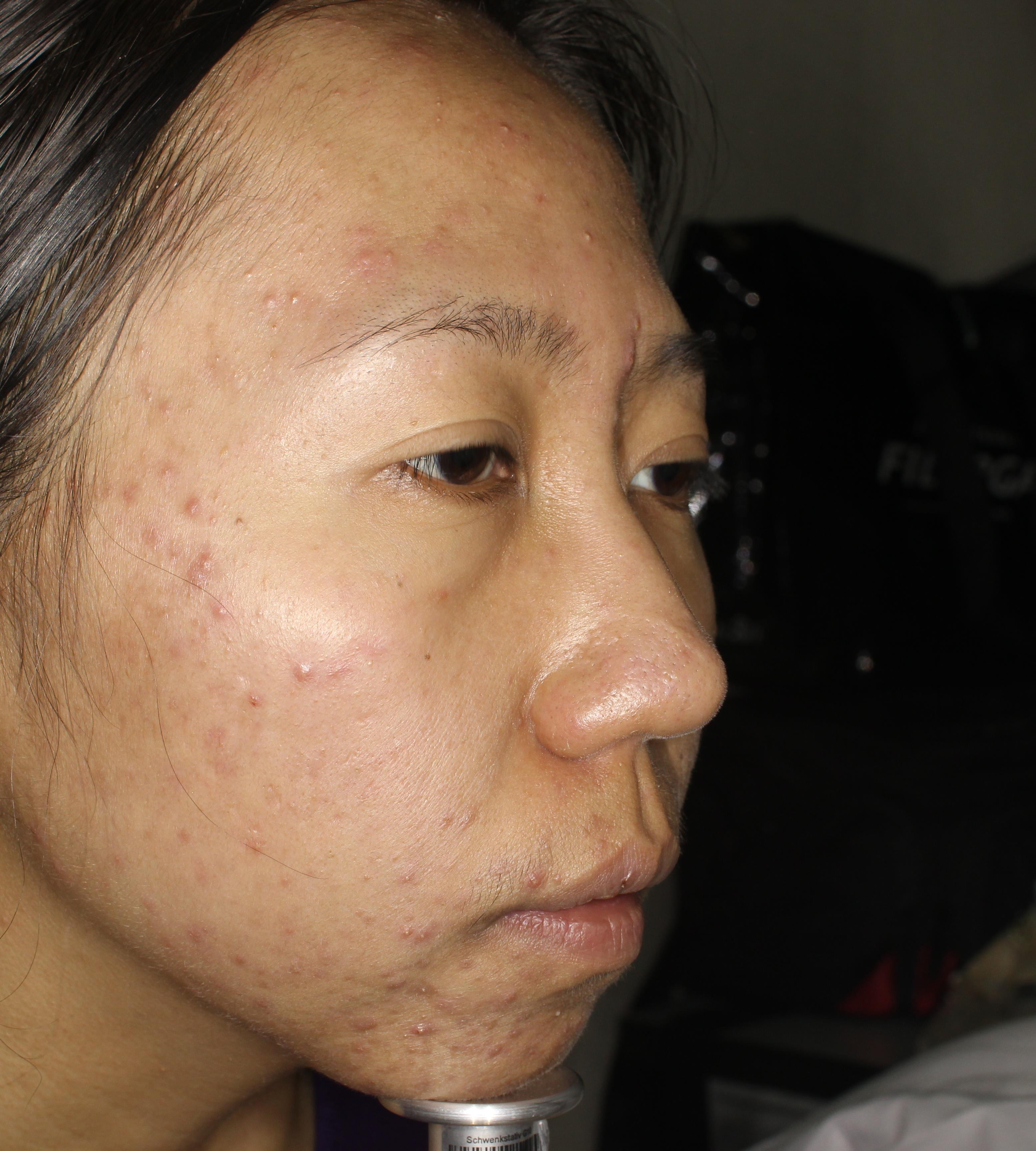 acne Object Detection Dataset by acne