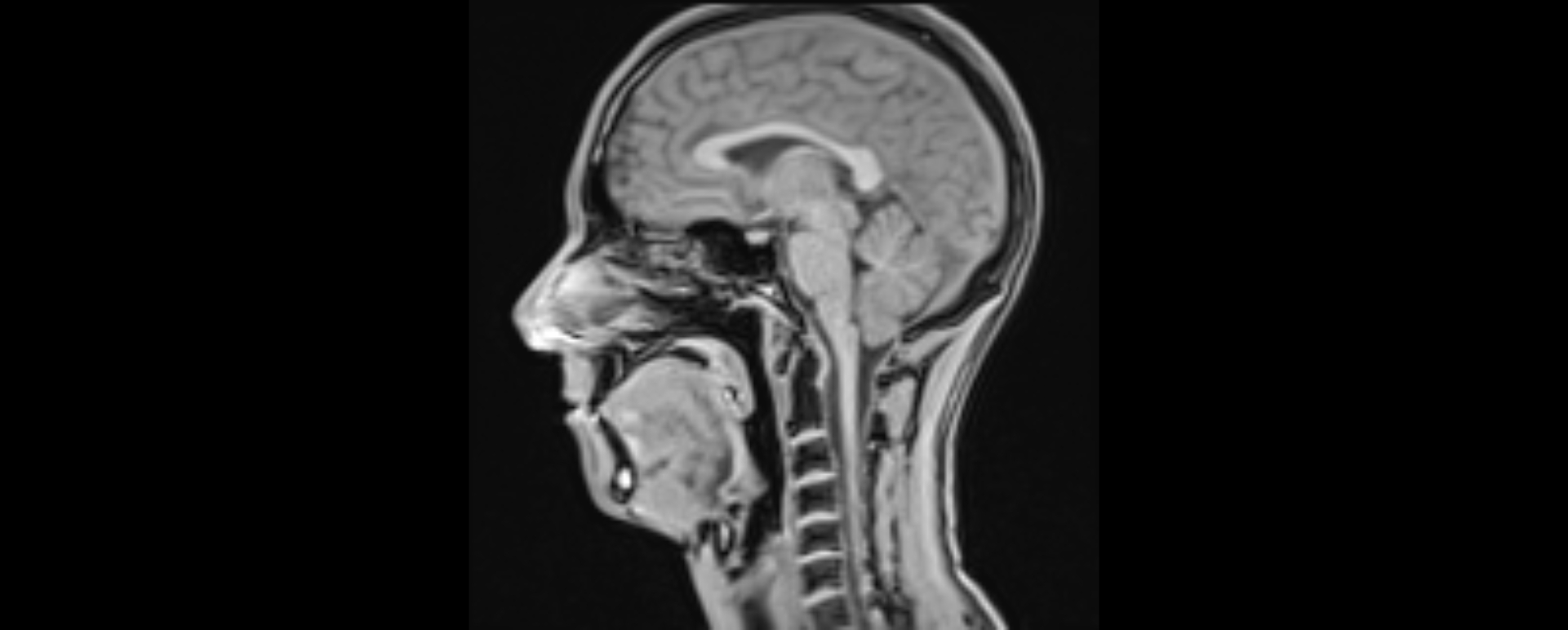 MRT images Cervical spine Instance Segmentation Dataset by Experimentation