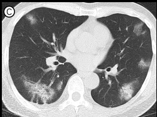 CT_scan Classification Dataset and Pre-Trained Model by azeemanwar789