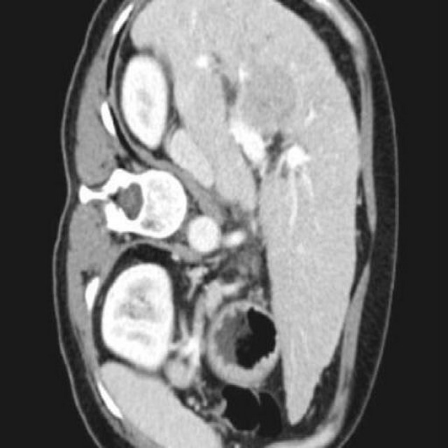 Project 5C Liver Tumor Instance Segmentation Model by SEGMENTASILIVER
