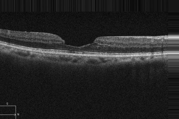 csr detection Classification Dataset by shehan