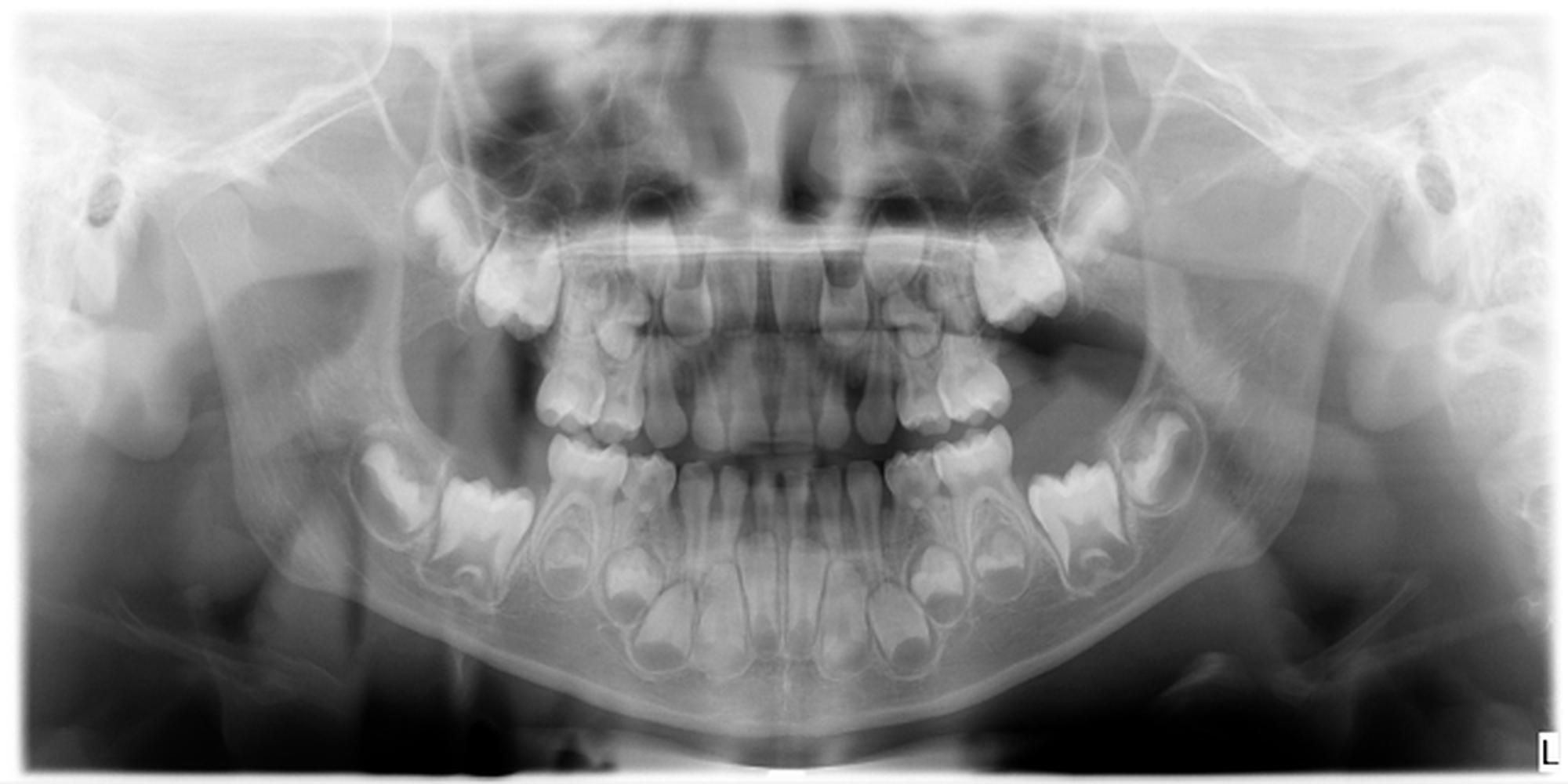 tooth Object Detection Model by hkoi
