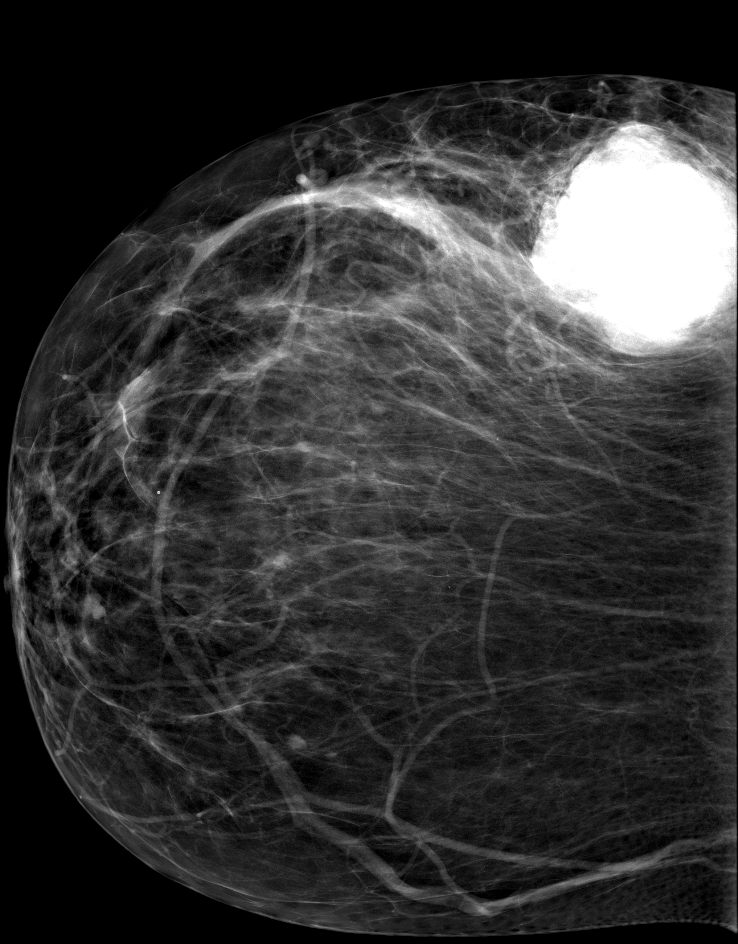 Early Detection Object Detection Model by Breast Cancer Detection