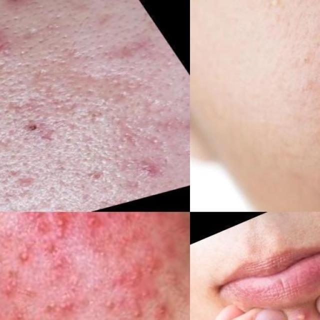 Acne classify Instance Segmentation Dataset and Pre-Trained Model by Acnefinal