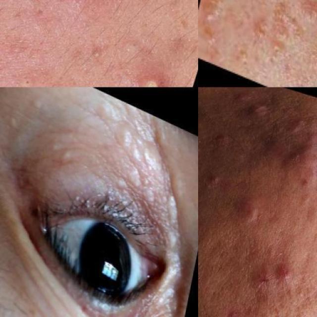 Classify_Acne Instance Segmentation Model by Acnefinal