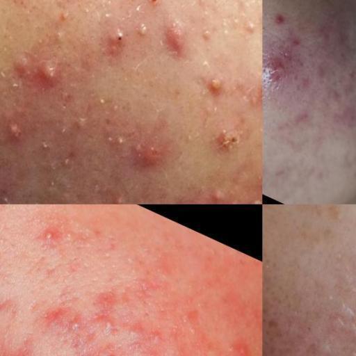 Acne Detection Object Detection Dataset By Acnefinal