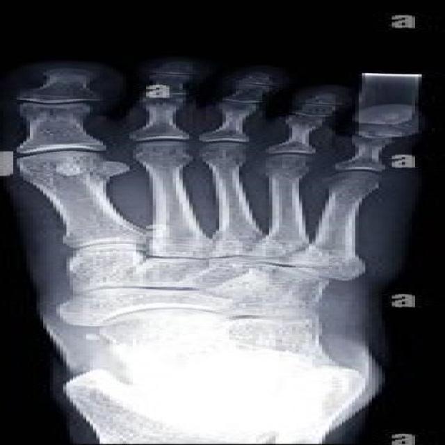 Bone Fracture Object Detection Model by yakin