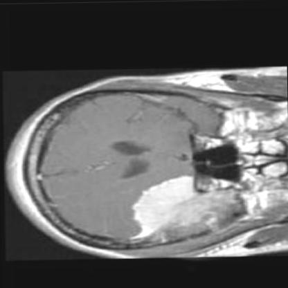 Brain Tumor Object Detection Dataset by Sandra