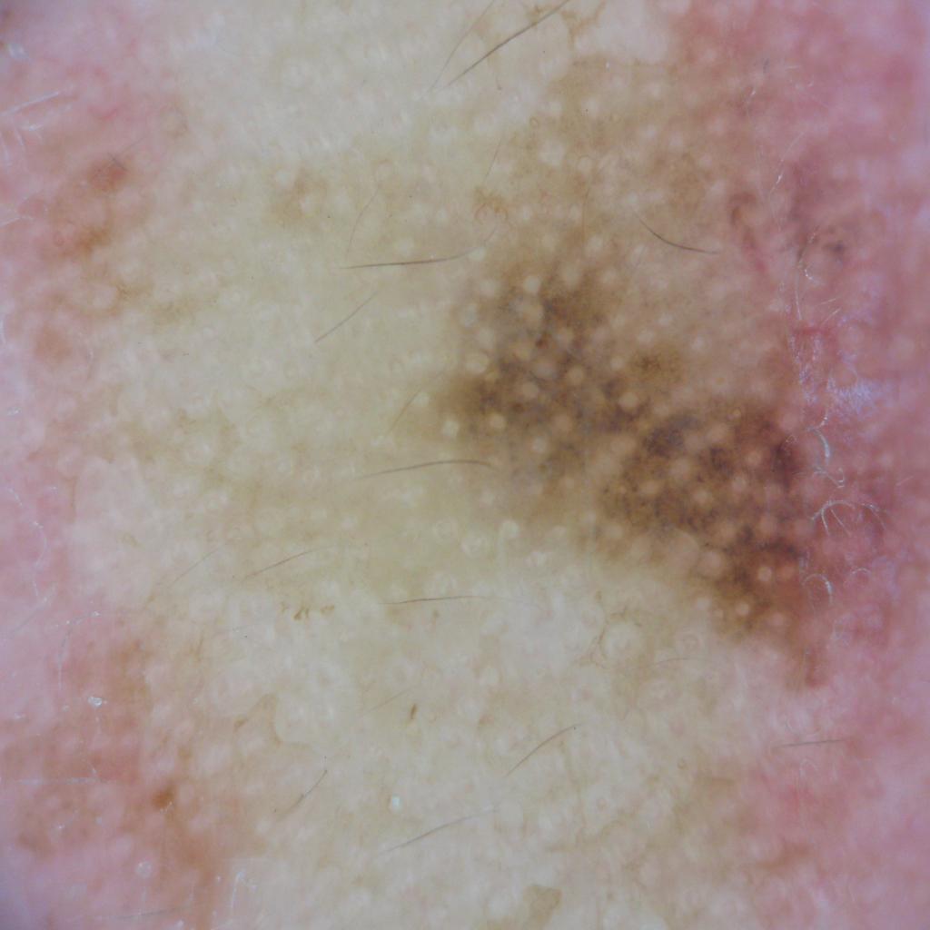 Skin Cancer BCC Instance Segmentation Dataset by Spectraproject