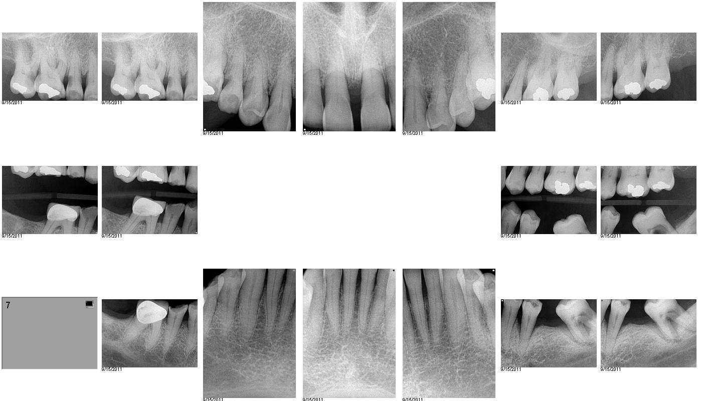 dental_cavity Object Detection Dataset by new-workspace-g0mlw