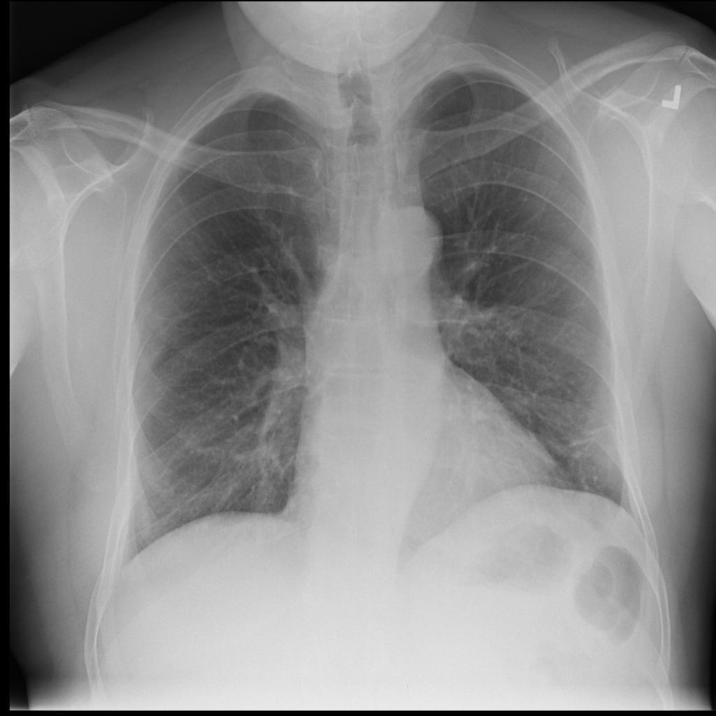 Lungs Classification Dataset and Pre-Trained Model by East