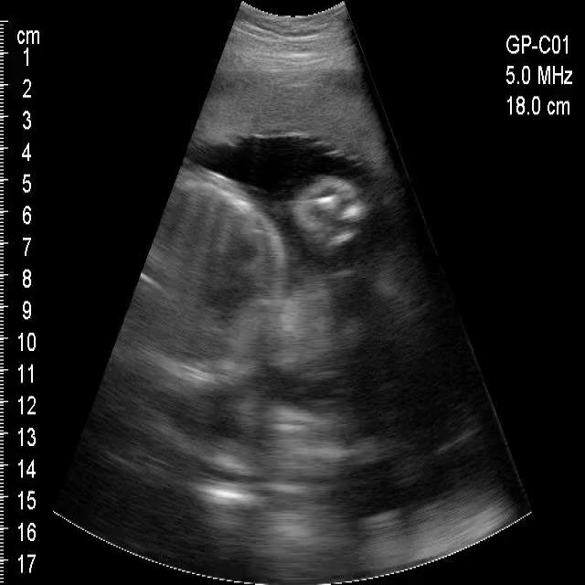 Af Detection Instance Segmentation Dataset And Pre Trained Model By Aafa